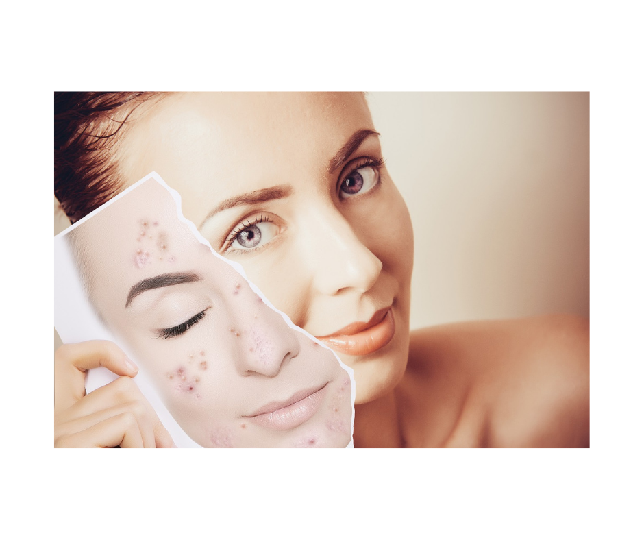 NATURAL METHOD TO GET ACNE FREE SKIN AT HOME