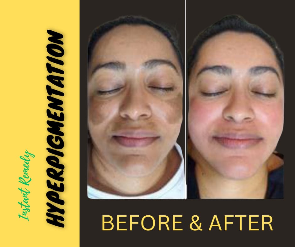 SKIN TONER FORMULA FOR PIGMENTATION AND DARK SPOTS