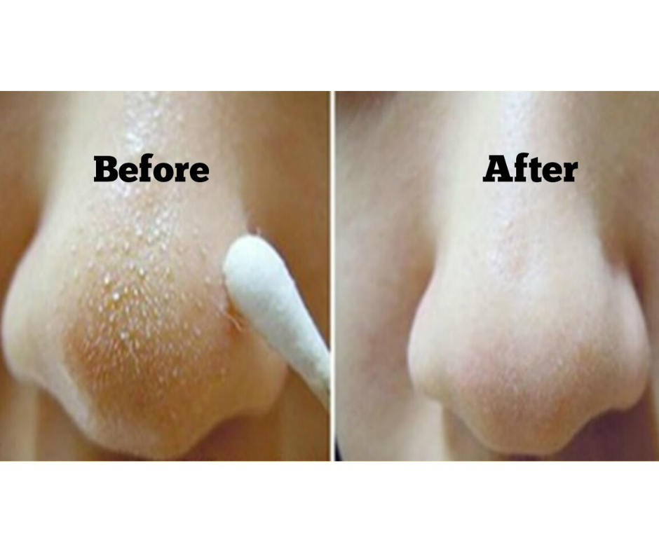 SIMPLE HOMEMADE BLACKHEAD REMOVAL REMEDY - V Beautify