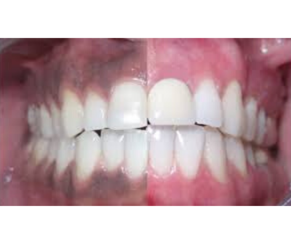 DIY ORAL CARE MASK FOR CLEAN GUMS - V Beautify