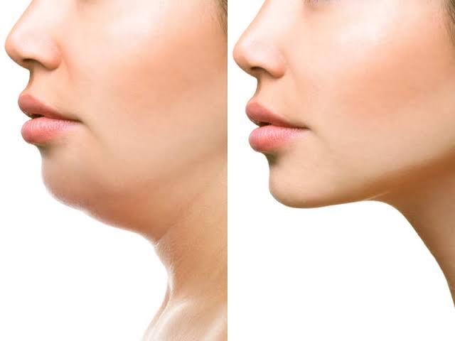 GET RID OF DOUBLE CHIN WITH THESE MEASURES