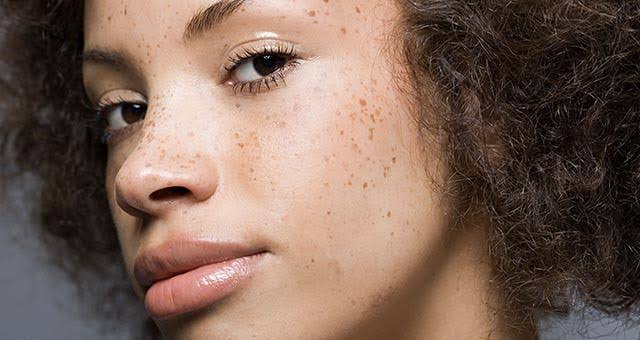 HOW TO GET RID OF FRECKLES FROM THE FACE