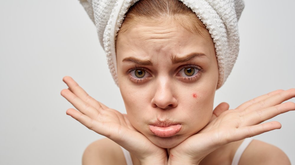 GET RID OF PIMPLES WITH THESE HOME CURES