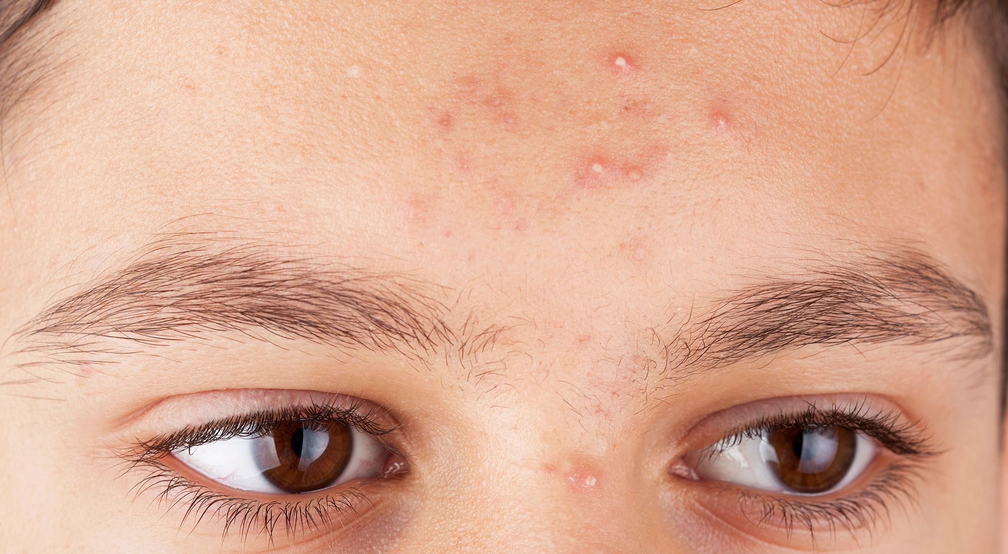 HOW TO GET RID OF PIMPLES ON FOREHEAD