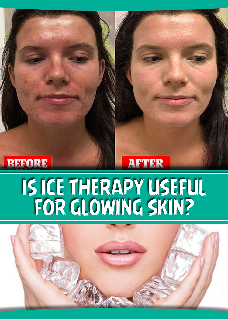 IS ICE THERAPY USEFUL FOR GLOWING SKIN?