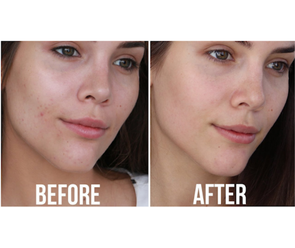 DIY SKINCARE MASK FOR ACNE SCARS - V Beautify