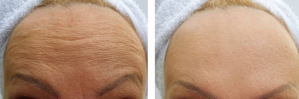 Tips To Get Rid Of Forehead Wrinkles At Home For Instant Result