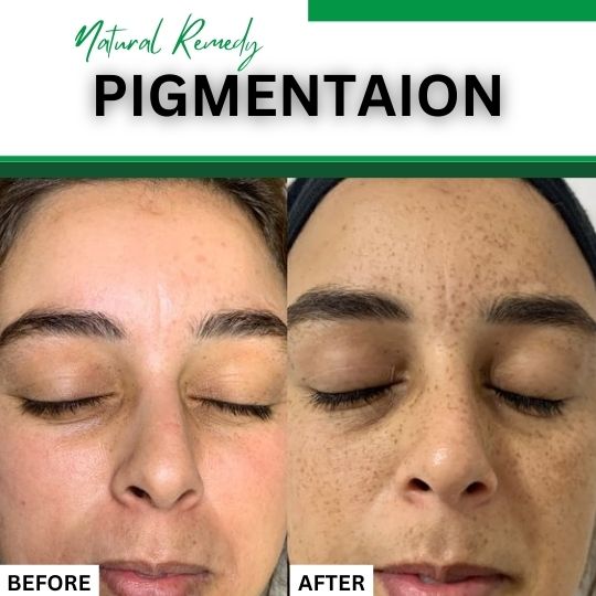Instant Remedies for Pigmentation - V Beautify