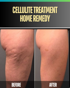 Effective Home Remedies for Cellulite Treatment - V Beautify
