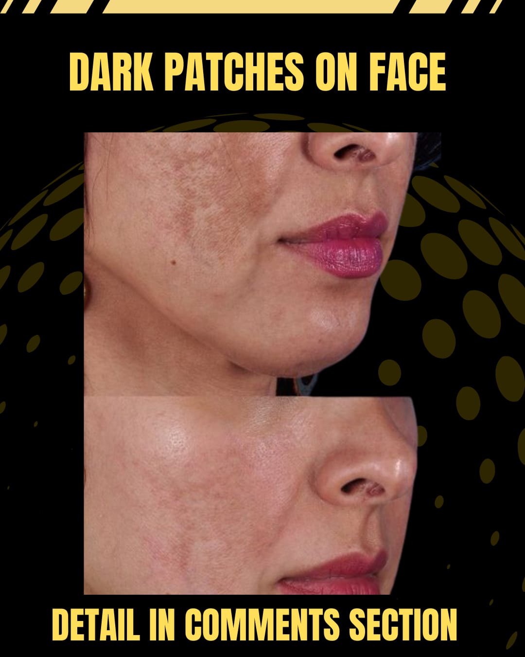 Home Remedies for Dark Patches on the Face - V Beautify
