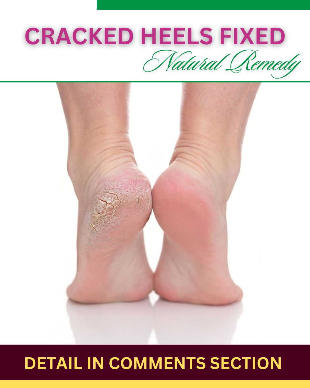 How to Fix Cracked Heels: Effective Home Remedies for Smooth and ...
