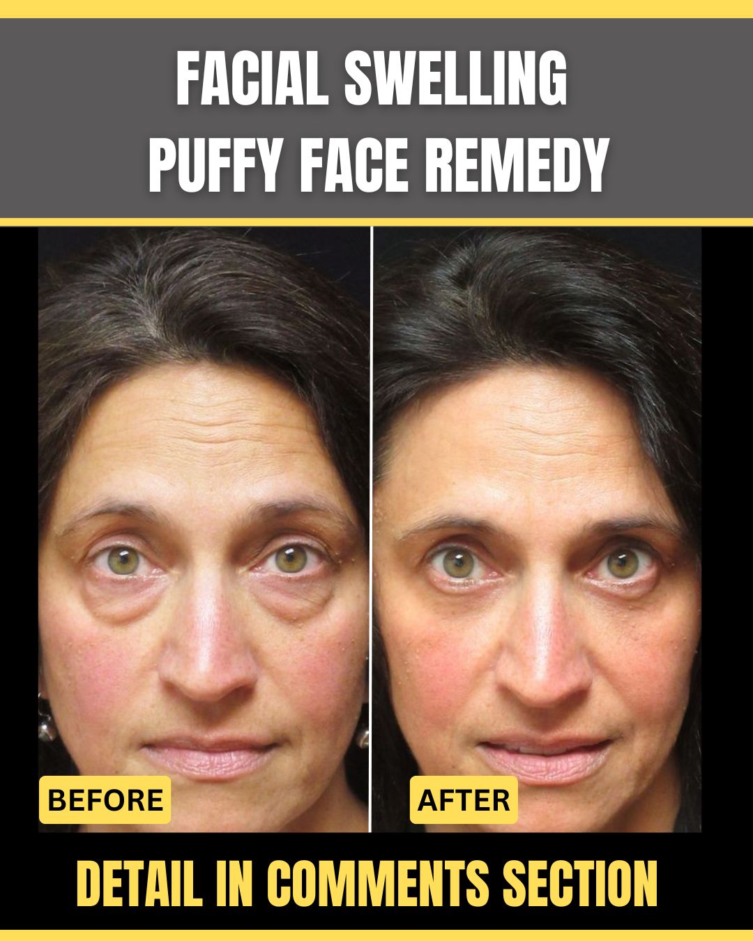 Natural Home Remedies for Facial Swelling and Puffy Face - V Beautify