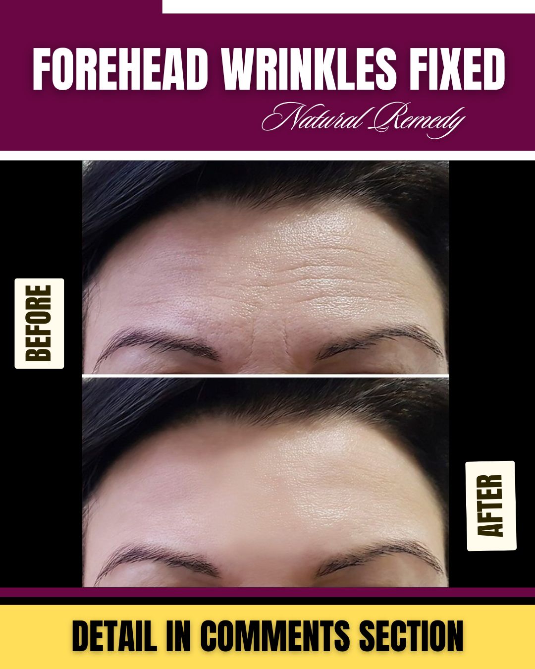 Natural Remedies for Forehead Wrinkles Using Kitchen Ingredients - V ...