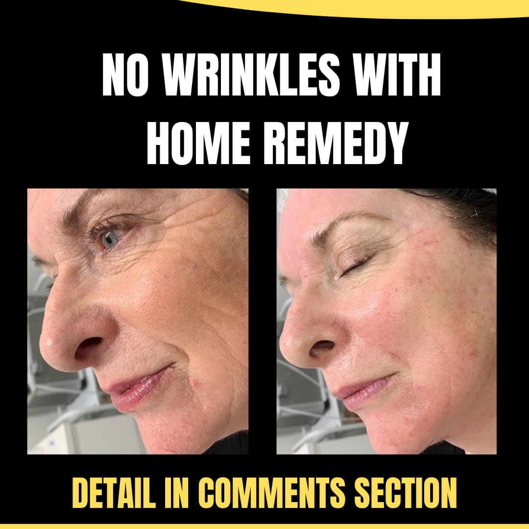 No Wrinkles with Home Remedies: Natural Solutions for Every Skin Type ...