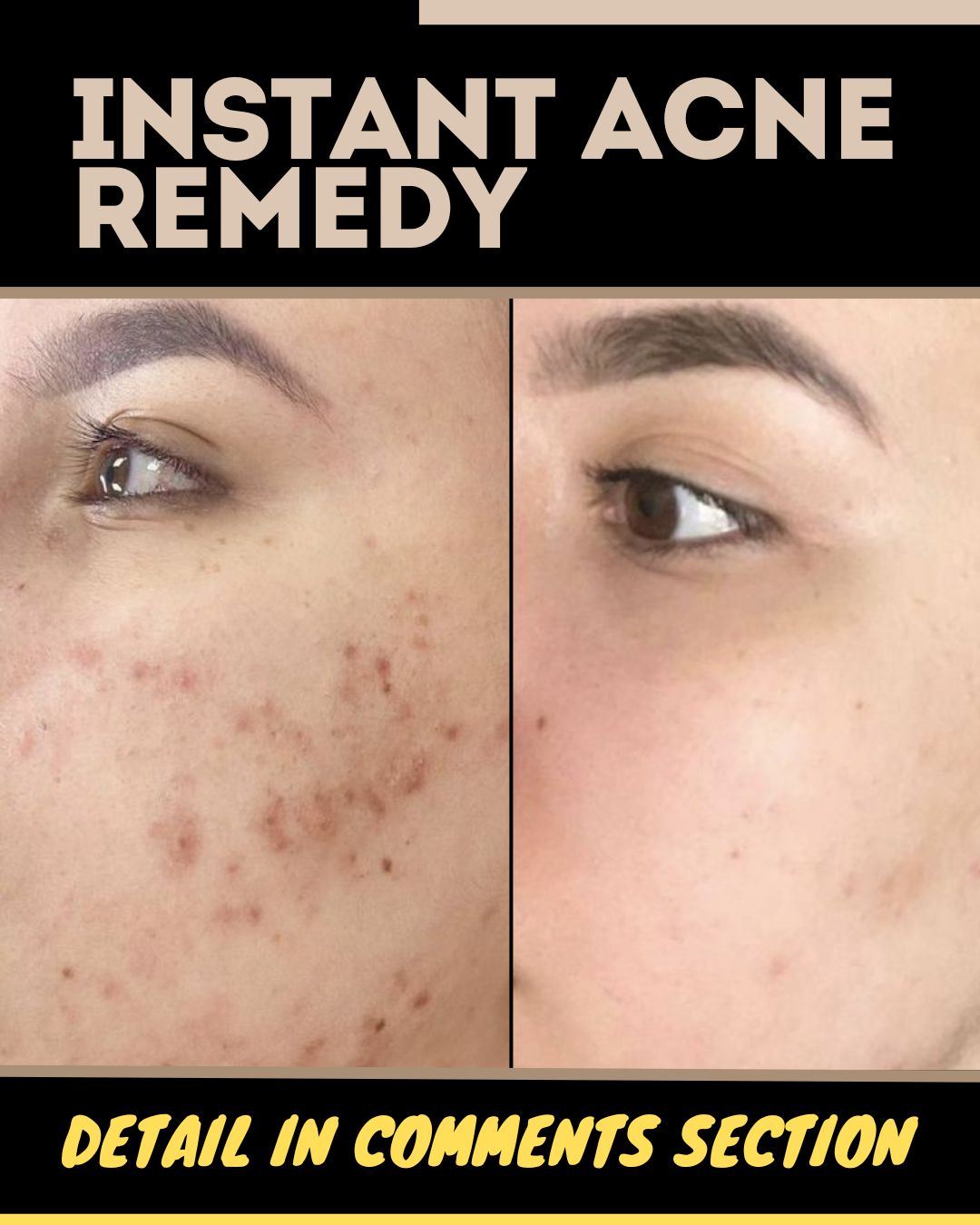Instant Acne Home Remedies - V Beautify