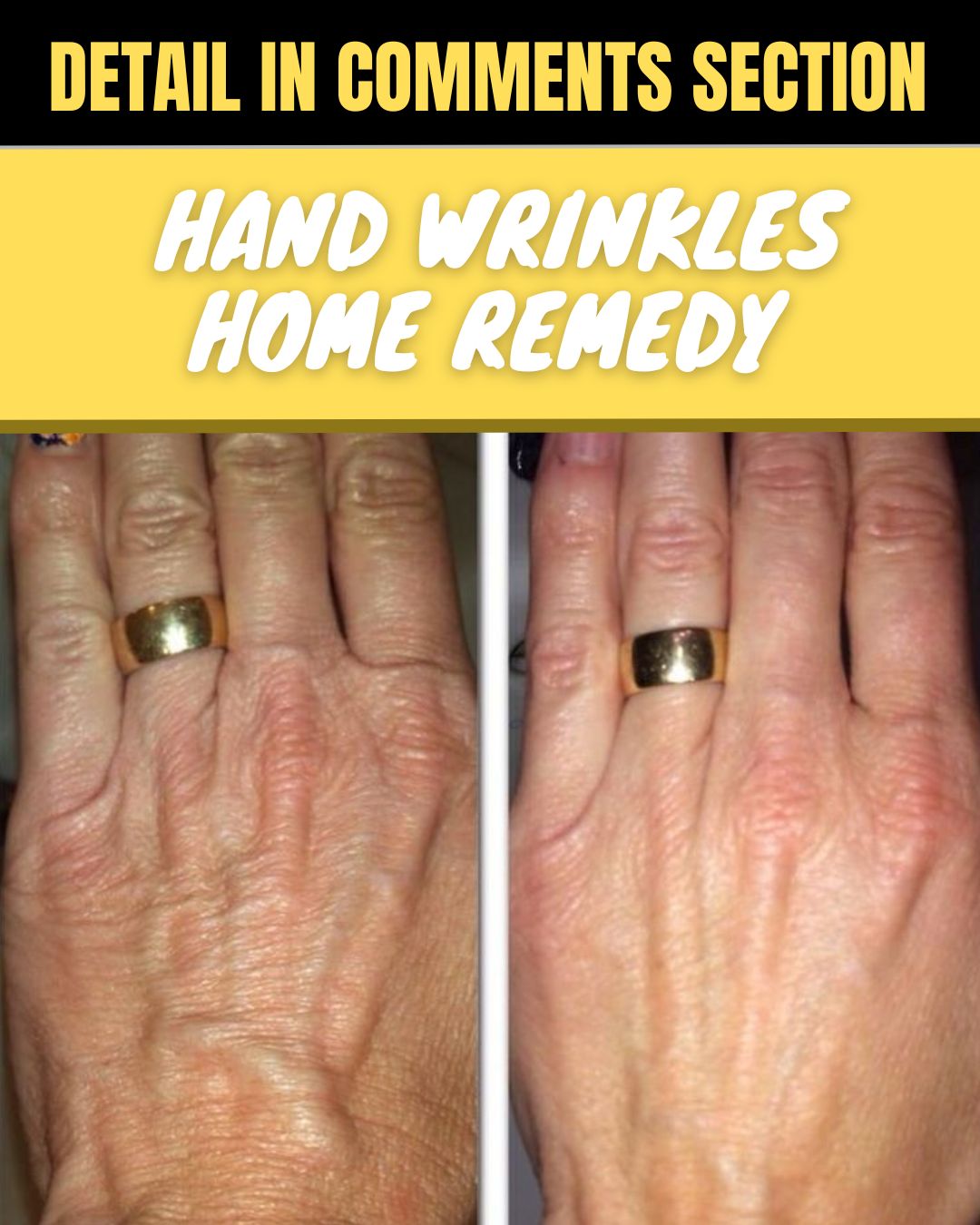Hand Wrinkles Home Remedies - V Beautify