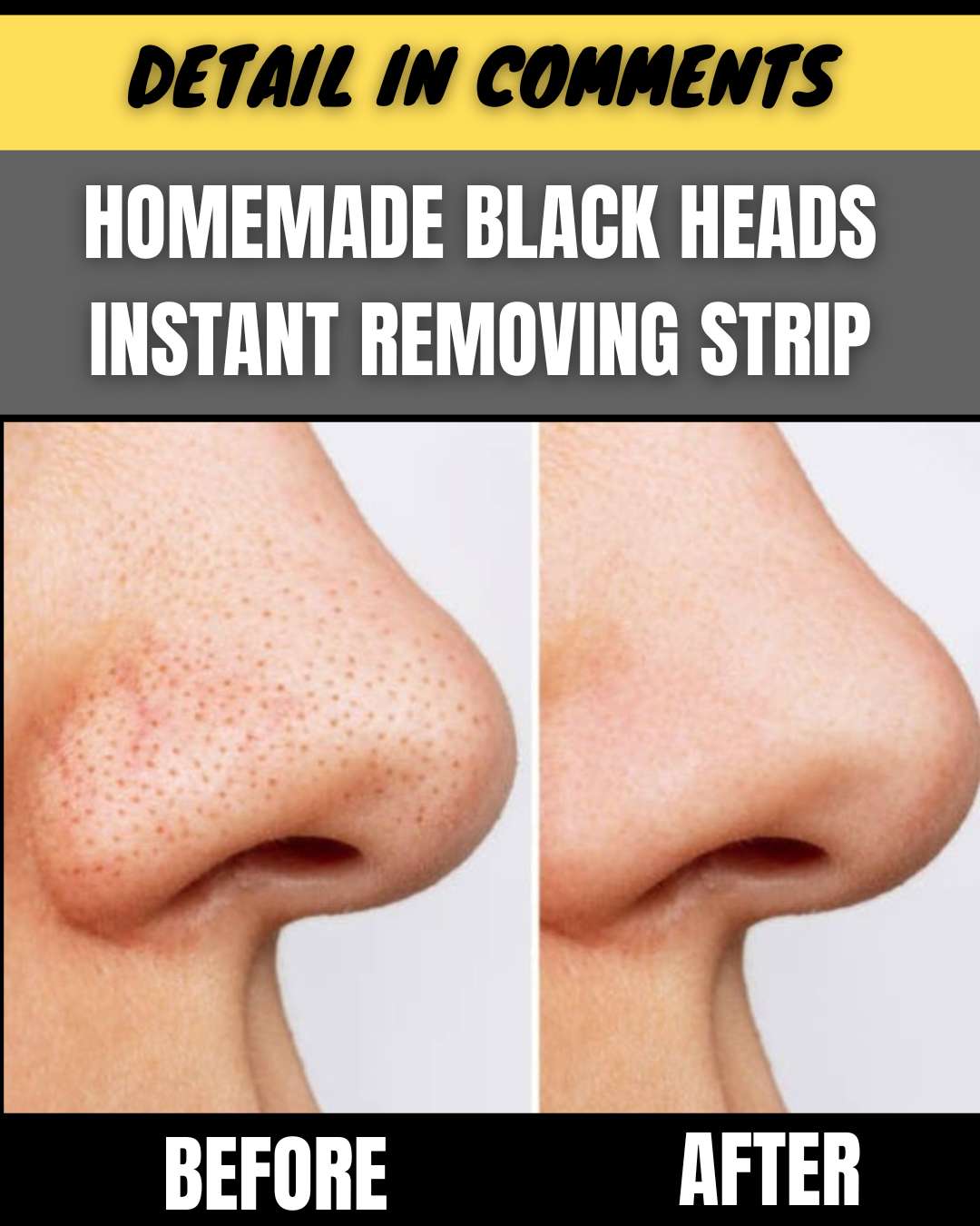 DIY Blackhead Removing Strips: Natural Remedies for Clear Skin - V Beautify