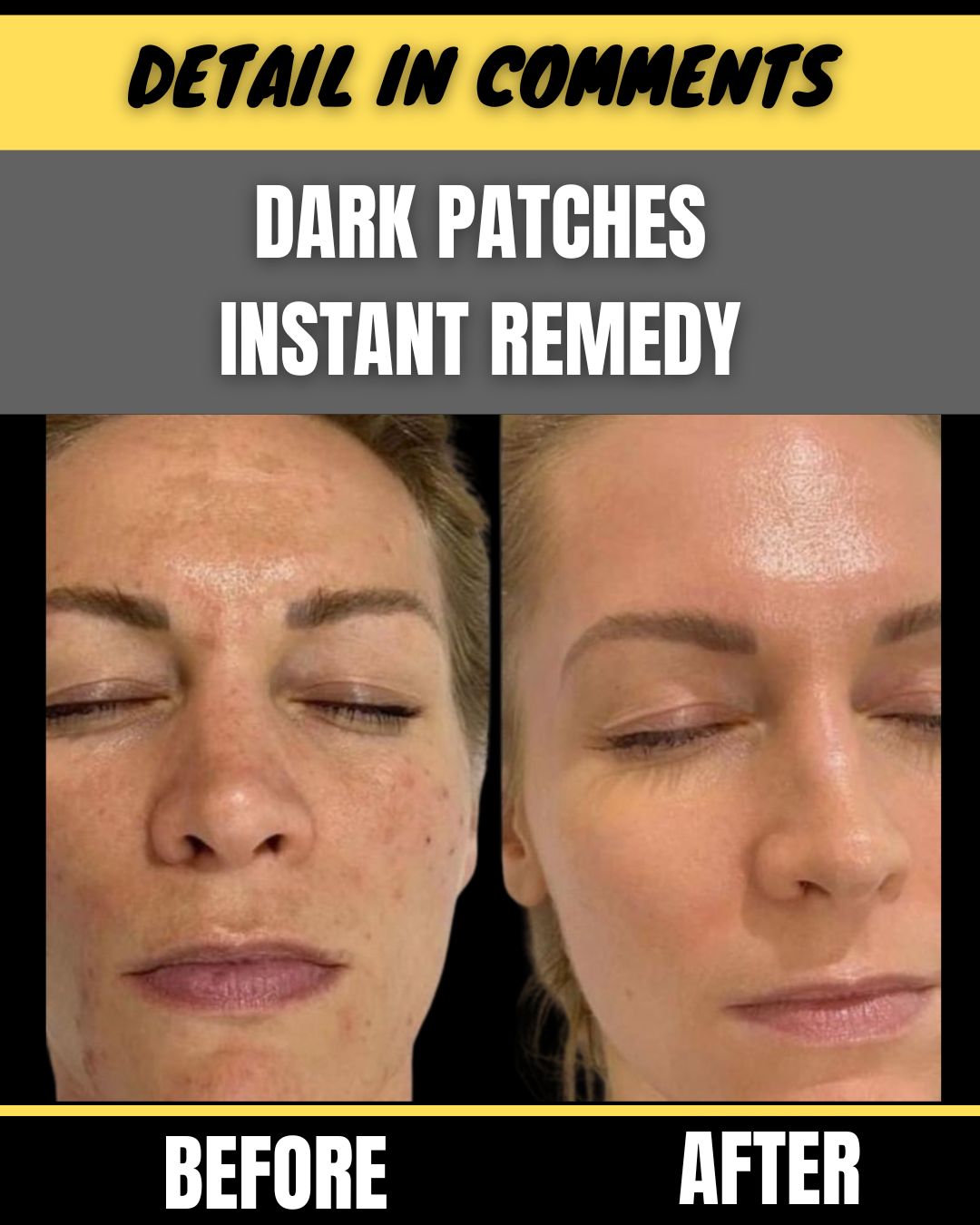 Instant Remedies for Dark Patches: Natural Home Treatments - V Beautify