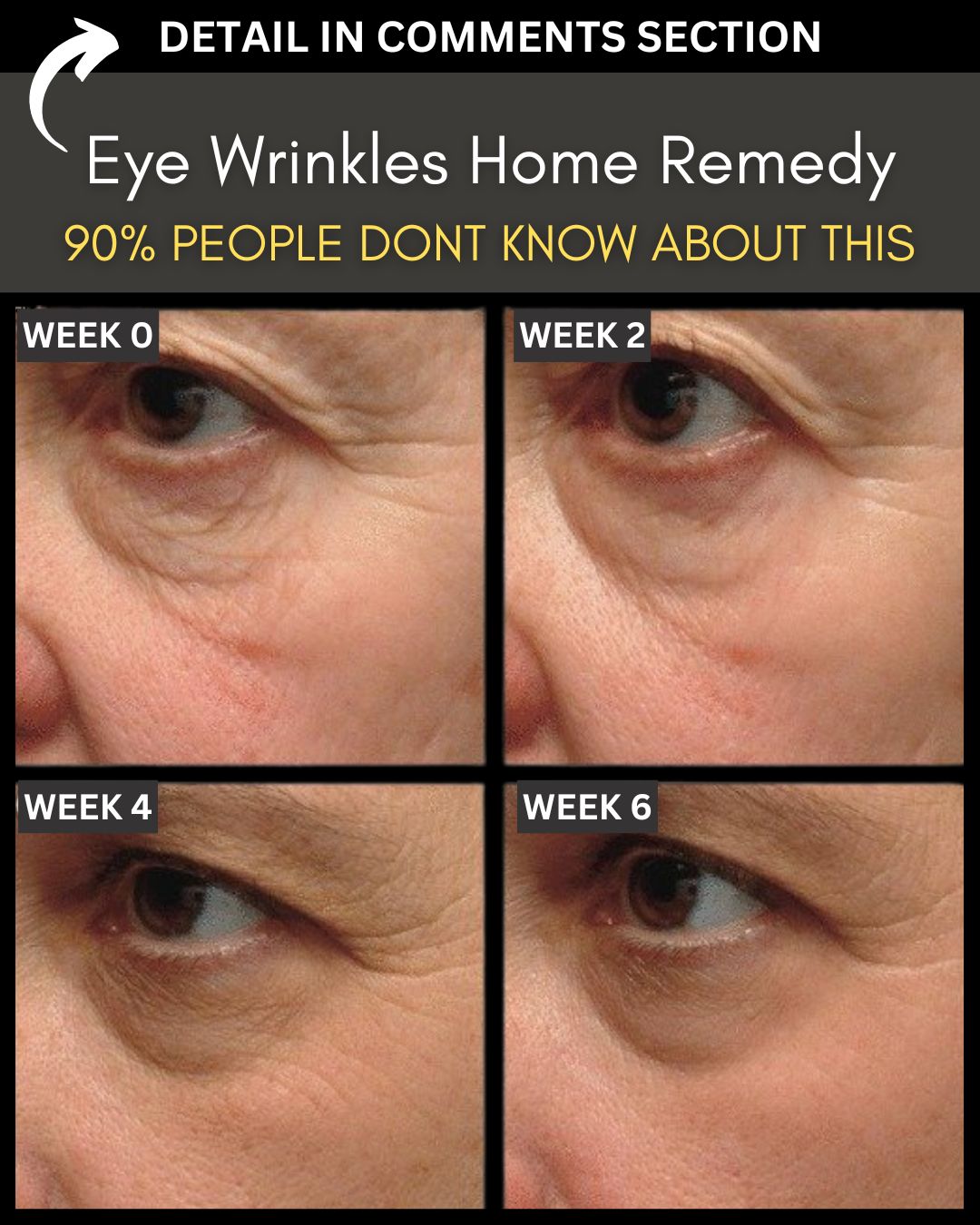 Eye Wrinkles Home Remedy: Natural Solutions for Every Skin Type - V ...