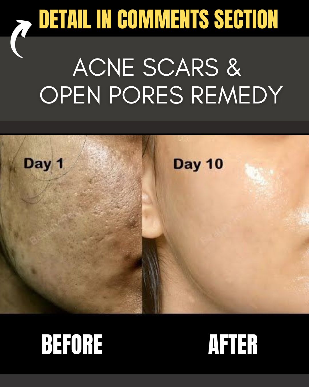 Acne Scars and Open Pores Remedy - V Beautify
