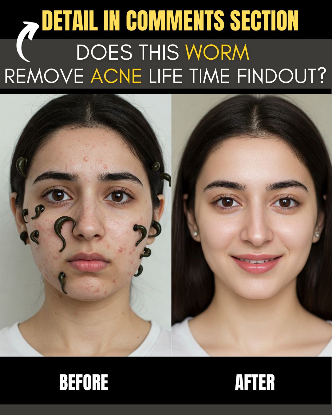 How Leech Therapy Can Remove Acne: Scientific Reasoning, Effectiveness ...
