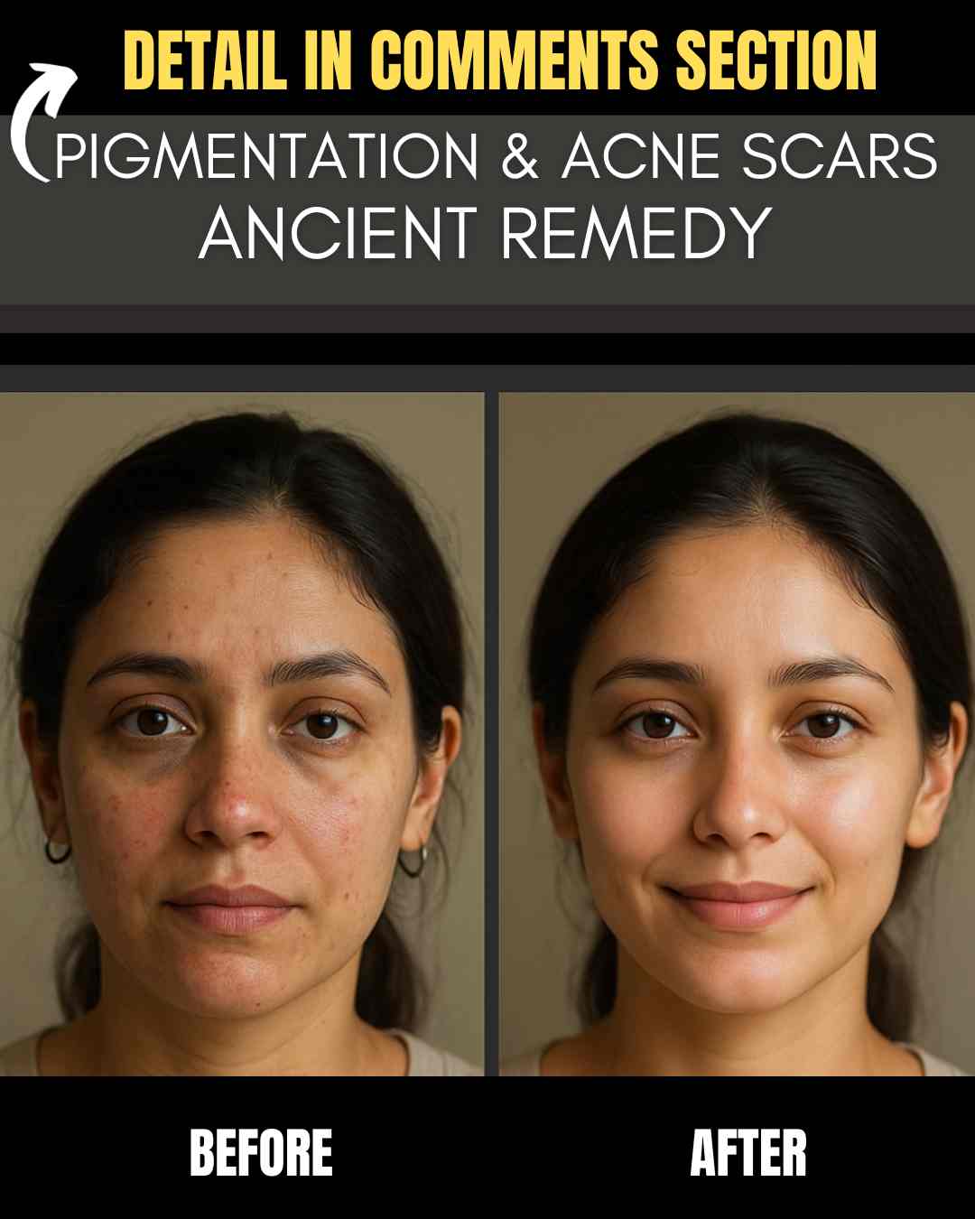 Pigmentation & Acne Scars – Ancient Remedies for Clear, Even-Toned Skin ...