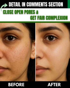 CLOSE OPEN PORES & GET FAIR COMPLEXION – NATURALLY BY SKIN TYPE - V ...