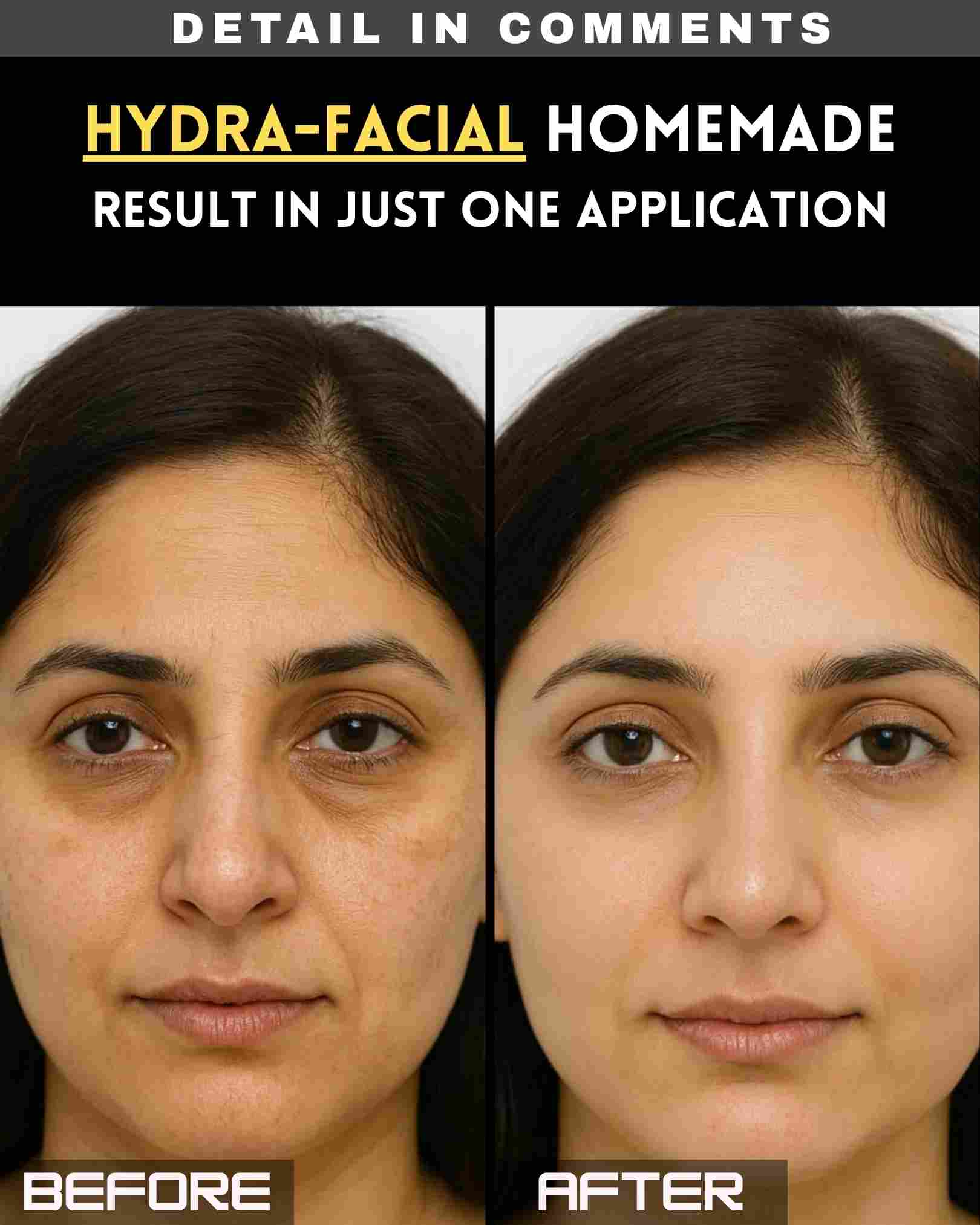 HYDRA-FACIAL HOMEMADE – INSTANT GLOW IN JUST ONE APPLICATION - V Beautify