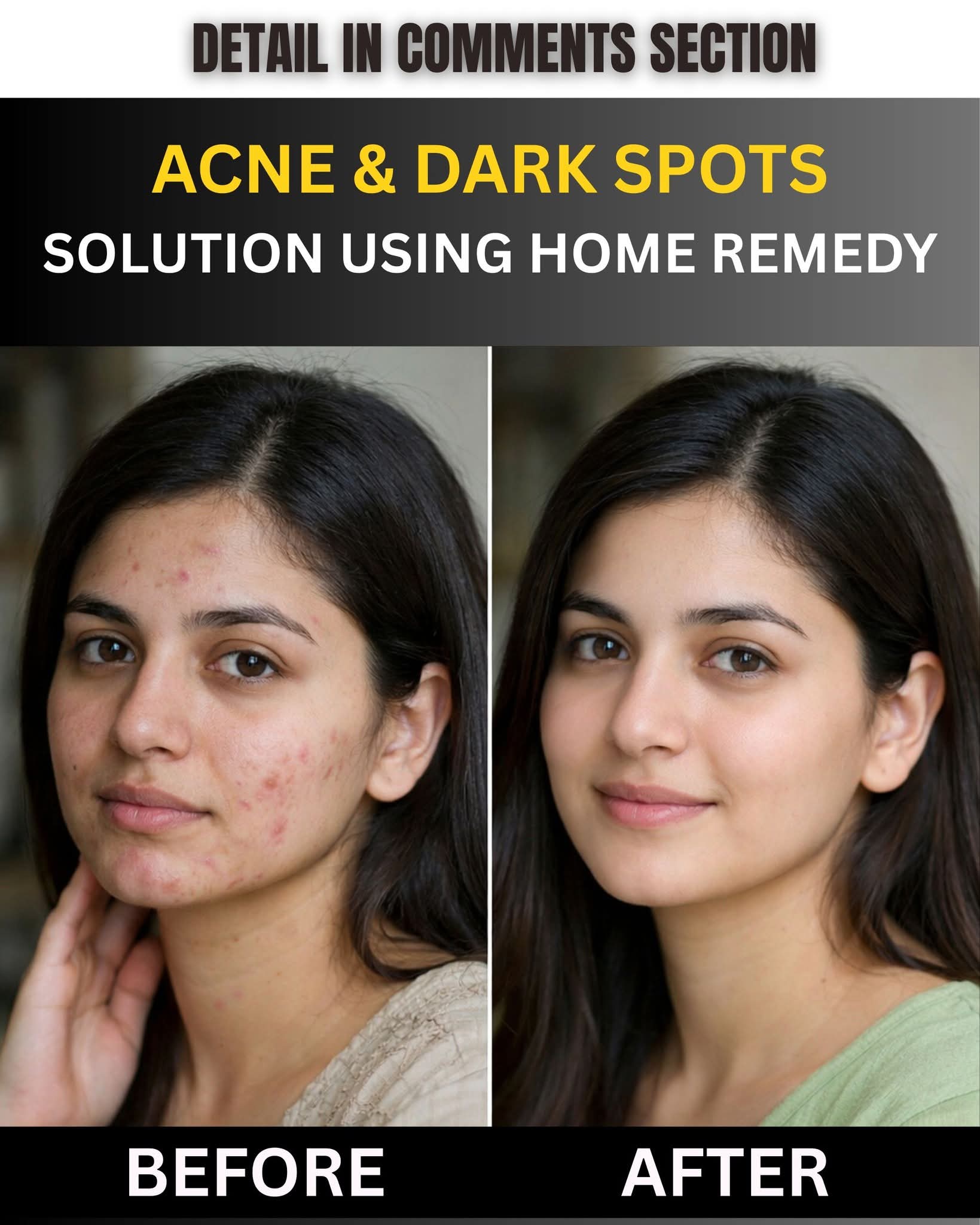 Acne and Dark Spots Solution Using Home Remedies (By Skin Type) - V ...