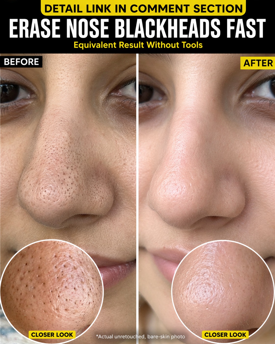 Fast Natural Remedies to Remove Nose Blackheads - V Beautify